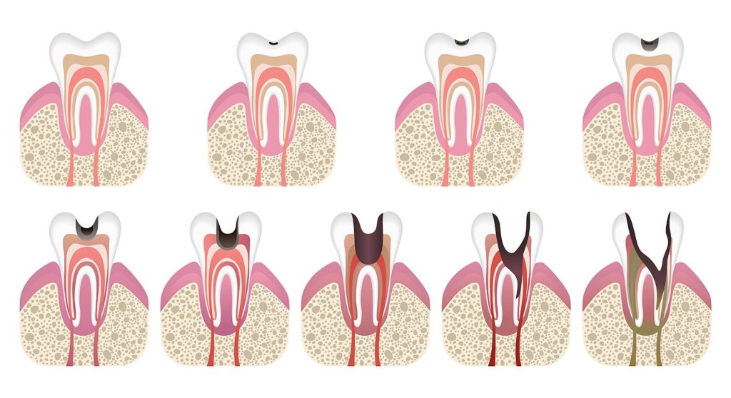 Understanding the Stages of Tooth Decay: Protecting Your Smile - Smile ...