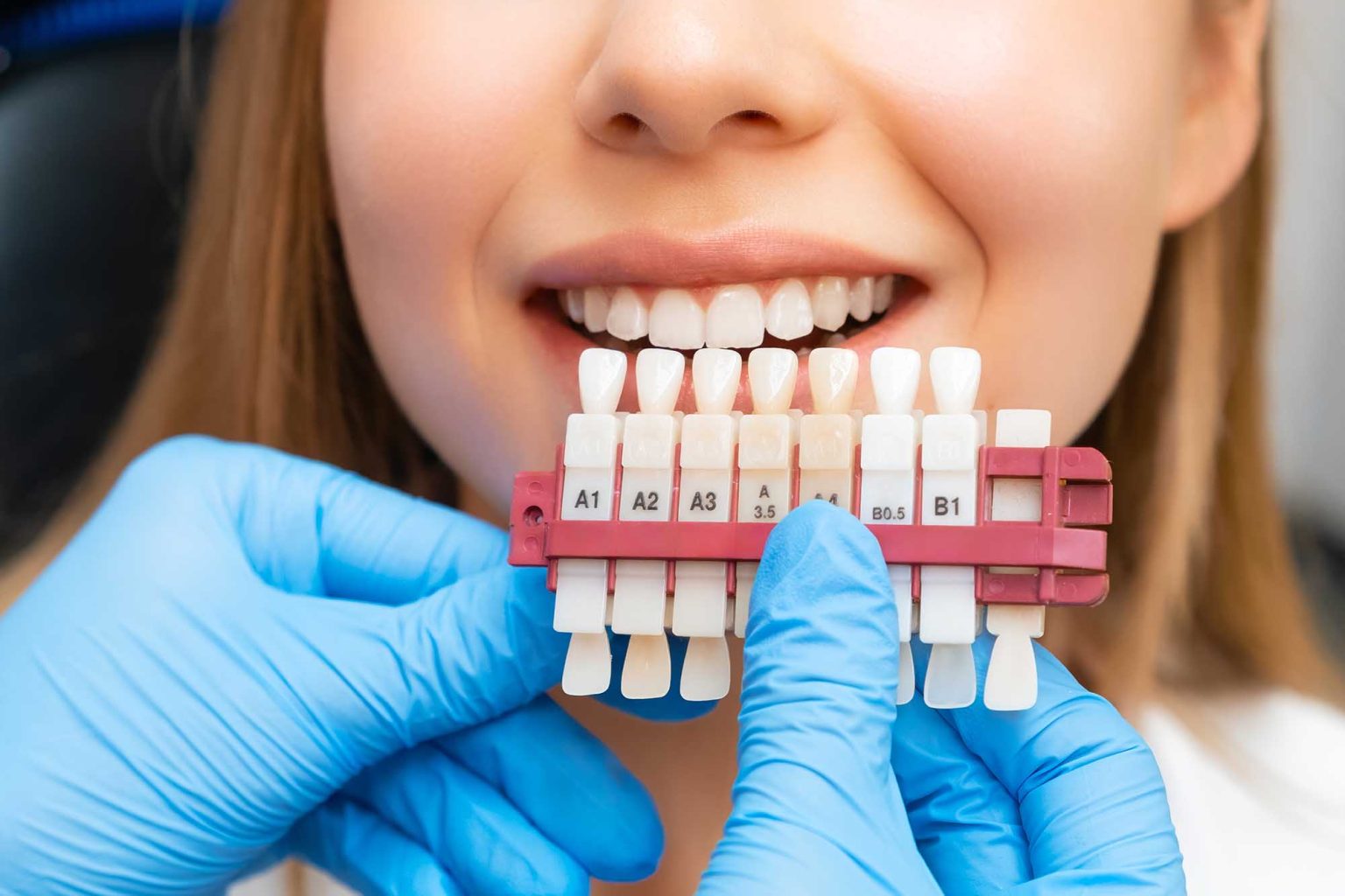 Everything You Need to Know About Composite Veneers