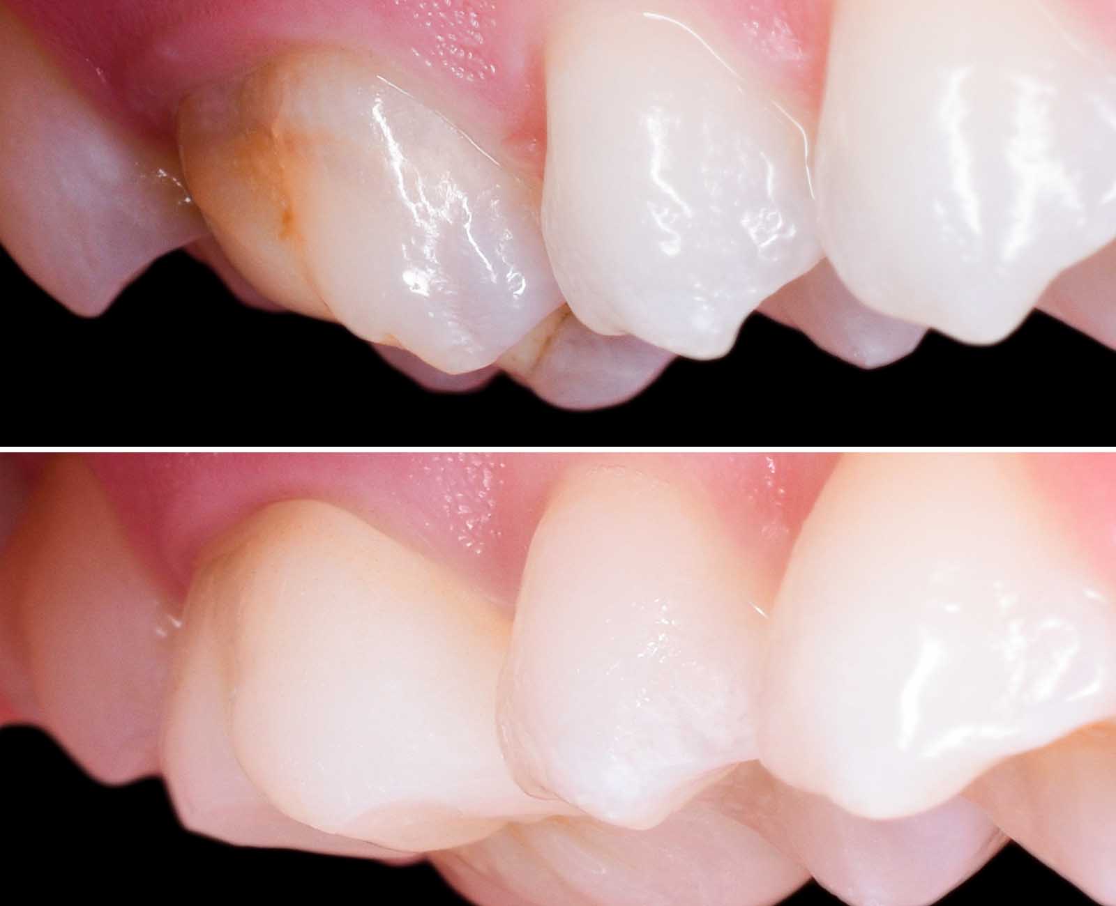 Porcelain Dental Crowns Starting From $875 Per Tooth